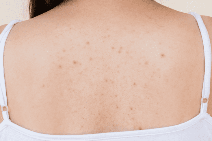 7 ways to combat back acne - Illuminate Skin Clinics